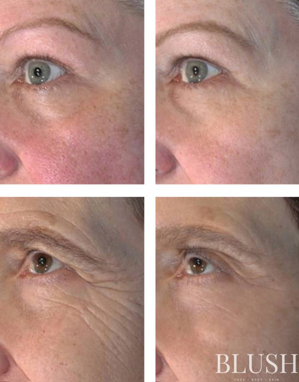 Microneedling met RF huidverjoning - Blush Clinic